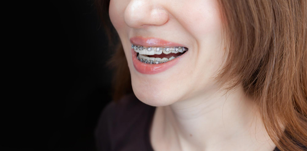 Dolore apparecchio fisso: come ridurlo? - Dott. Matteo Zappa - Medico ...